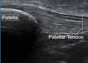 Wat is een tendinopathie? | Peesexpertchris